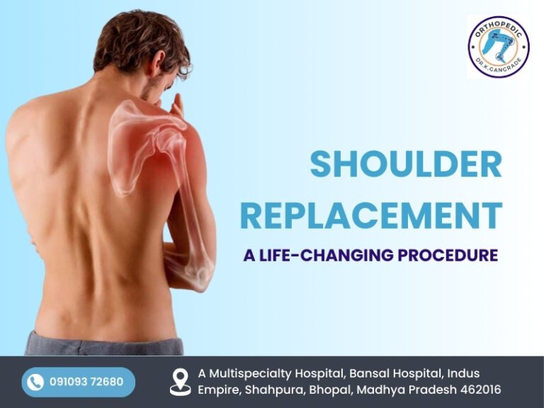 Shoulder Replacement Surgery in Bhopal: Everything You Need to Know ...